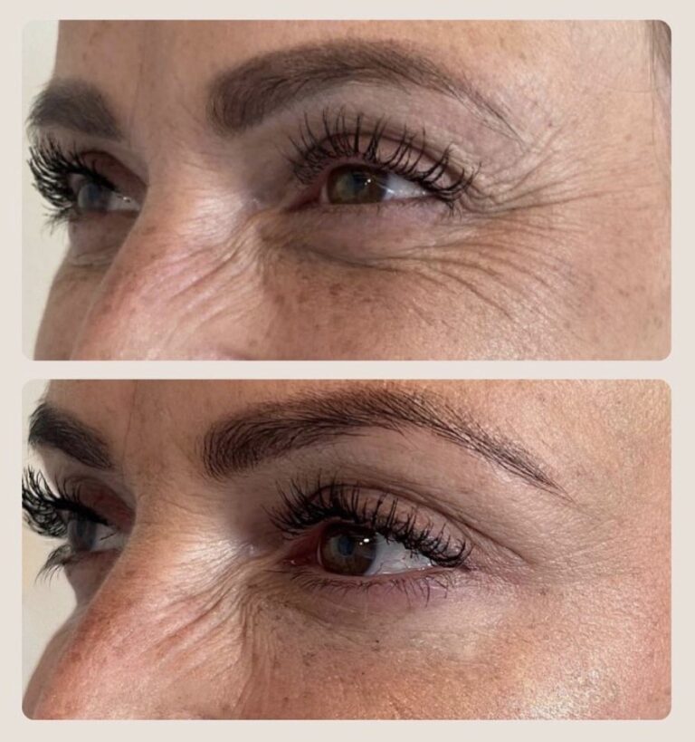 Botox of bocouture? Wat is het verschil? | Ontdek het hier!