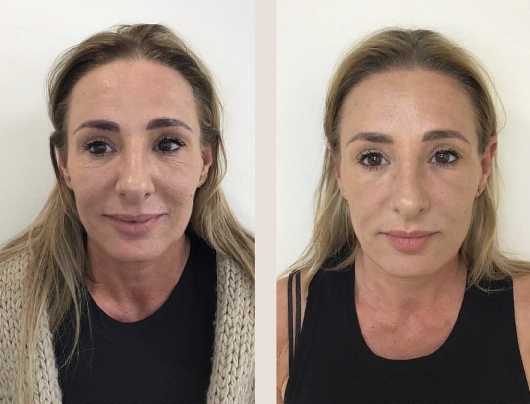 Geen vermoeide uitstraling meer dankzij Traangoot Fillers?